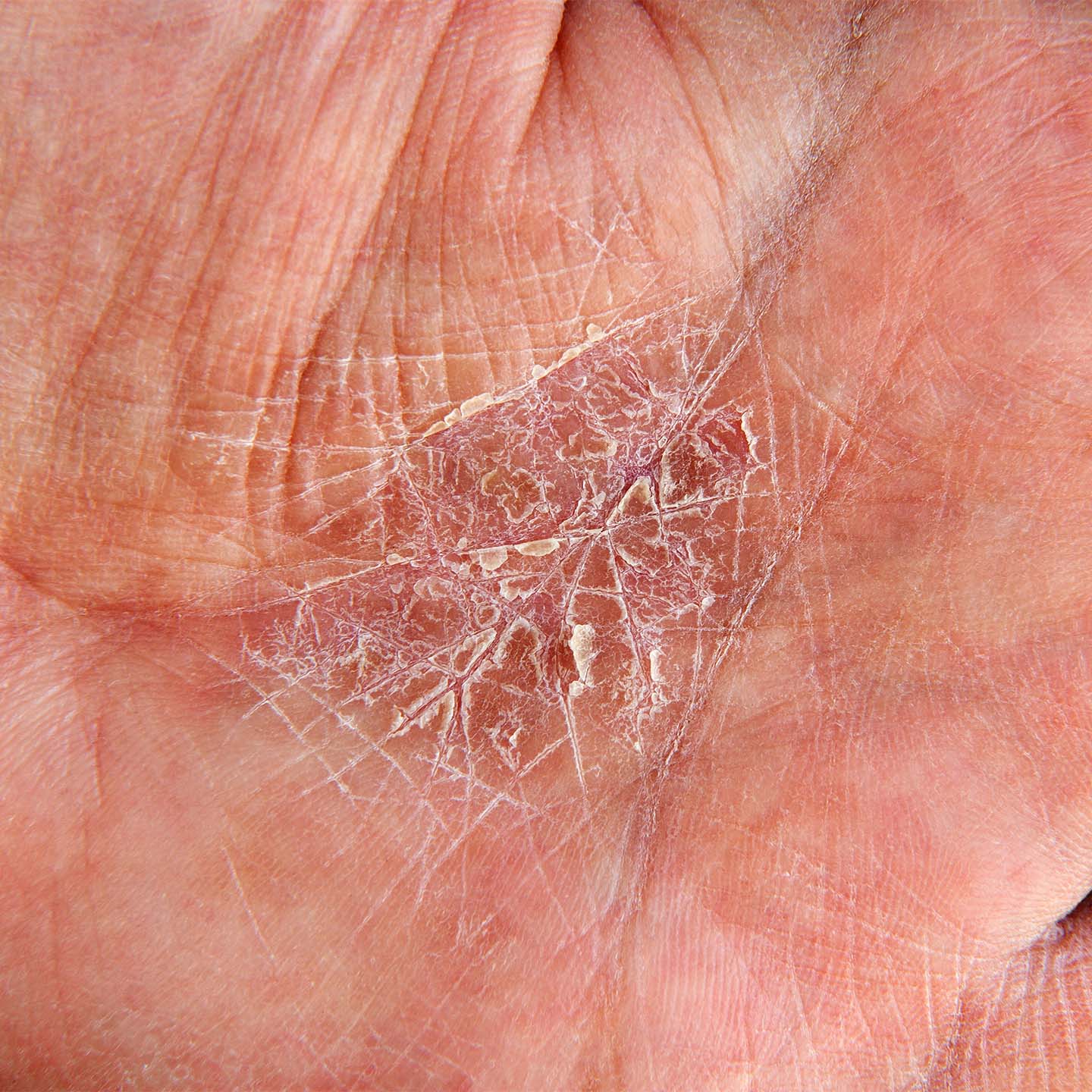 10 weetjes over eczeem, en hoe je het kan beheersen - Skinsights